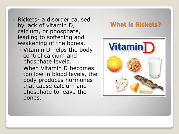 PPT - Rickets PowerPoint Presentation - ID:2451262