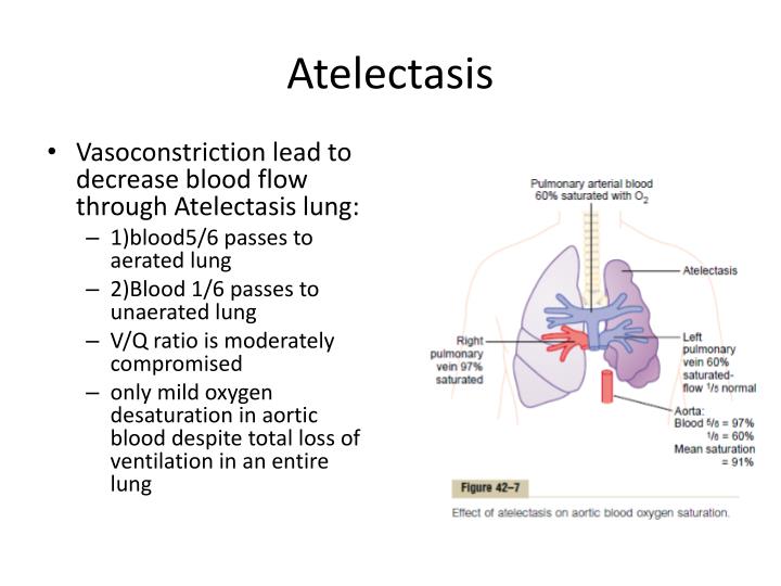 PPT - Atelectasis PowerPoint Presentation - ID:2457217