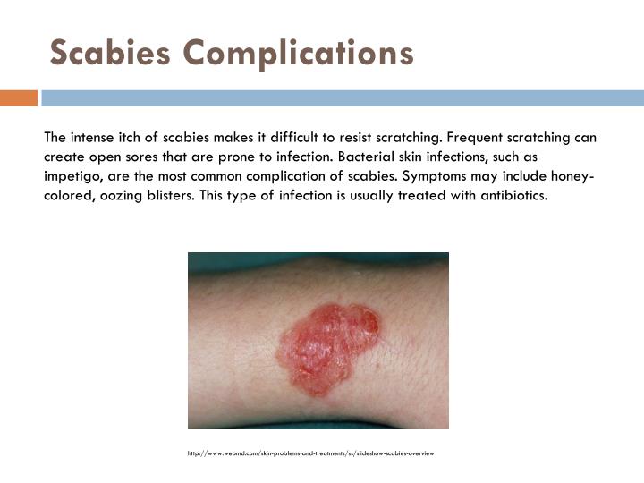 PPT - What Is Scabies? PowerPoint Presentation - ID:2457230