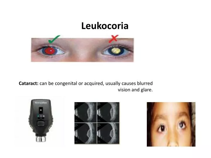 PPT - Leukocoria PowerPoint Presentation, free download - ID:2460389