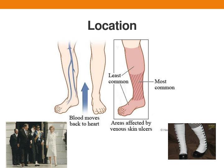 PPT - Venous Stasis Management and Ulcer Healing PowerPoint ...