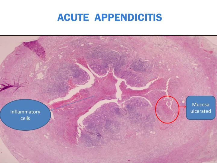PPT - Inflammation and repair PowerPoint Presentation - ID:2476337