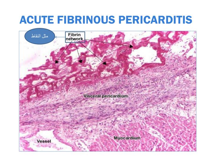 PPT - Inflammation and repair PowerPoint Presentation - ID:2476337