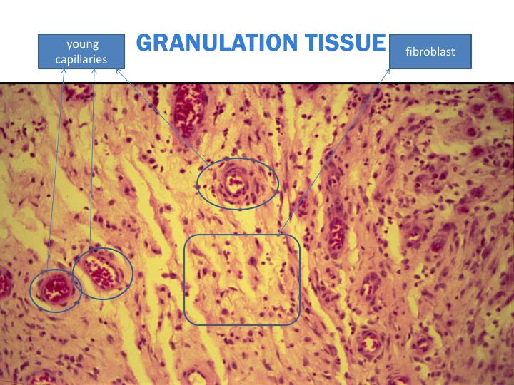 PPT - Inflammation and repair PowerPoint Presentation - ID:2476337