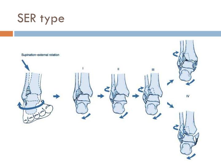 PPT - Detecting factors of Syndesmotic injury in Ankle Fx . in ...