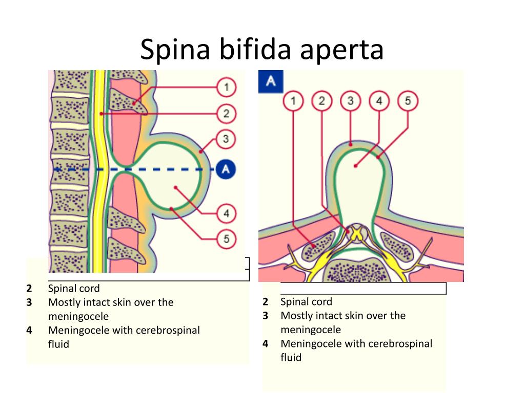 PPT - Spina bifida occulta PowerPoint Presentation, free download - ID ...