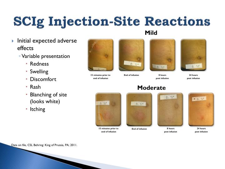 PPT - IVIg vs SCIg How to Choose? PowerPoint Presentation - ID:2481099