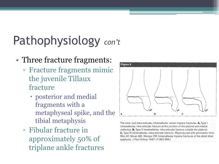 PPT - The Pediatric Triplane Ankle Fracture PowerPoint Presentation ...
