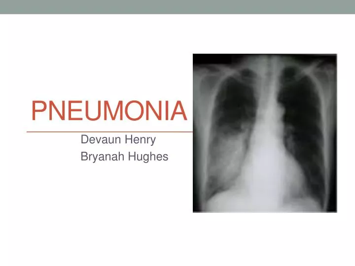 PPT - Pneumonia PowerPoint Presentation, free download - ID:2490515