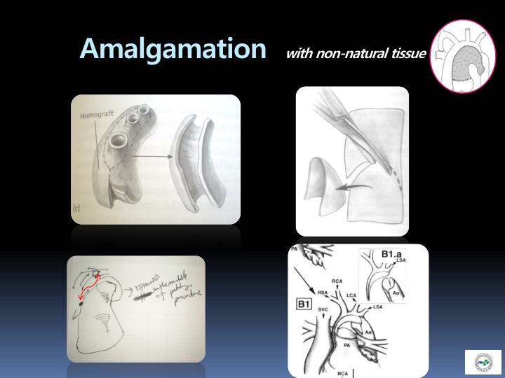 PPT - Damus -Kaye- Stansel & Norwood , as procedures . PowerPoint ...