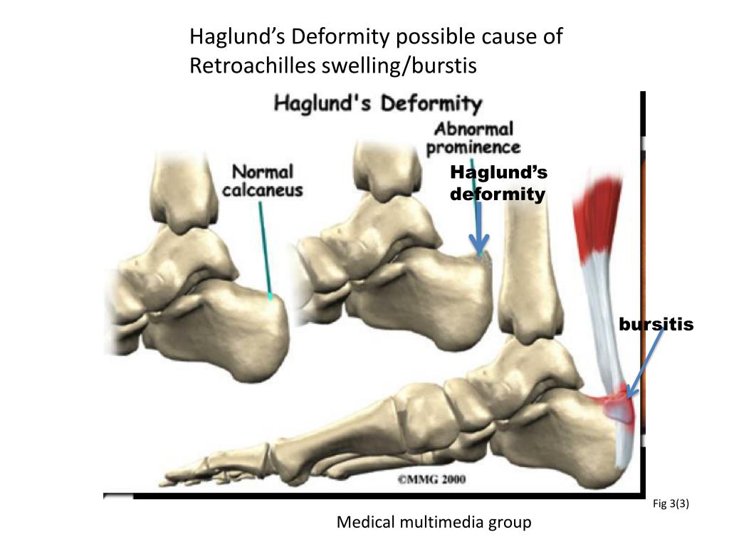 PPT - ACHILLES TENDON & Plantaris Tendon PowerPoint Presentation - ID ...