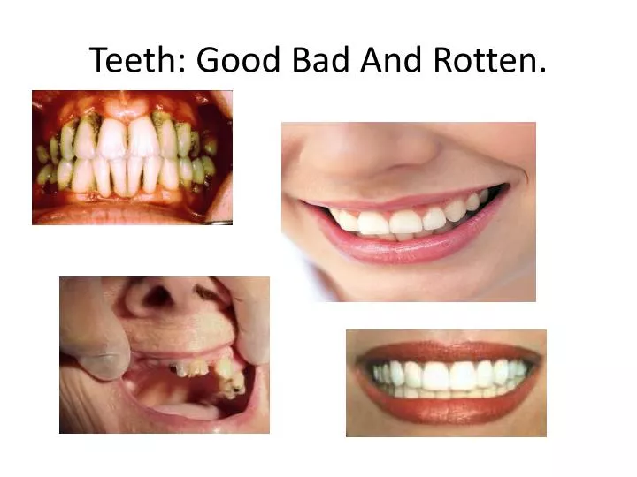 PPT - Teeth: Good Bad And Rotten. PowerPoint Presentation, free ...