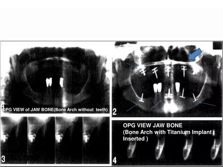 PPT - OPG VIEW of JAW BONE(Bone Arch without teeth) PowerPoint ...