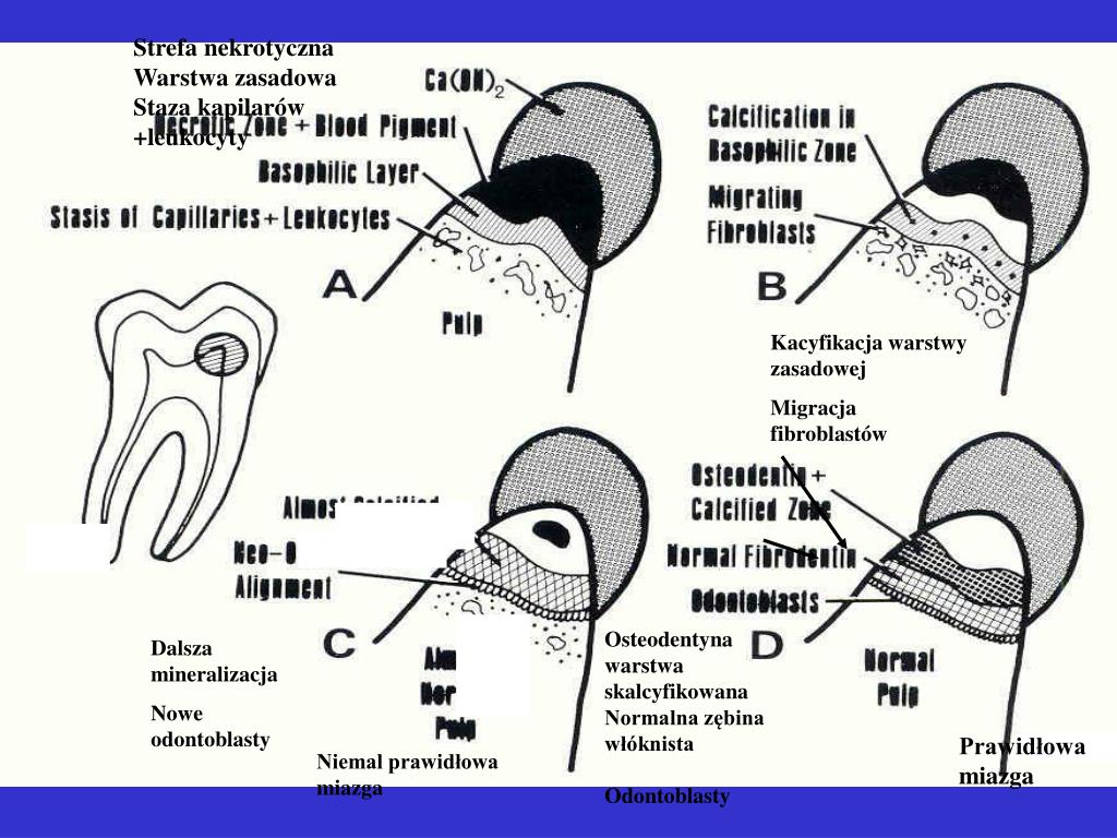 PPT - CHOROBY MIAZGI ZĘBÓW STAŁYCH NIEDOJRZAŁYCH PowerPoint ...