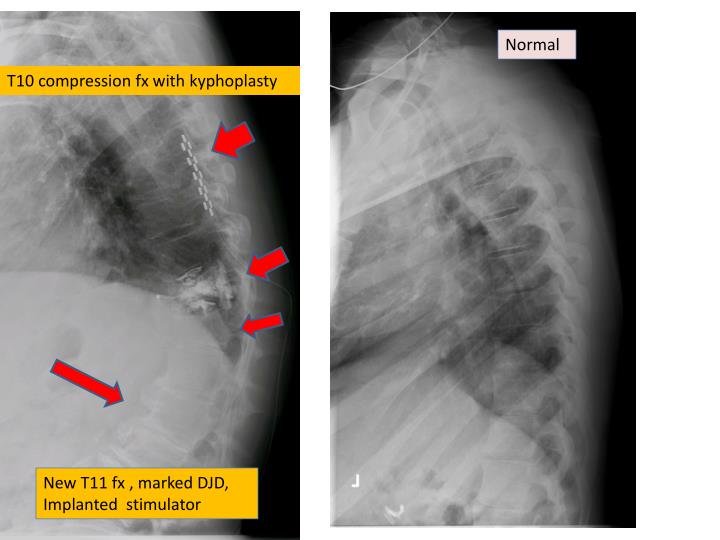 PPT - Lumbar Spine PowerPoint Presentation - ID:2521553