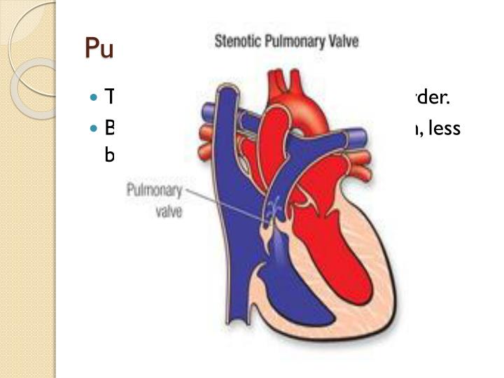 Pulmonary Valve