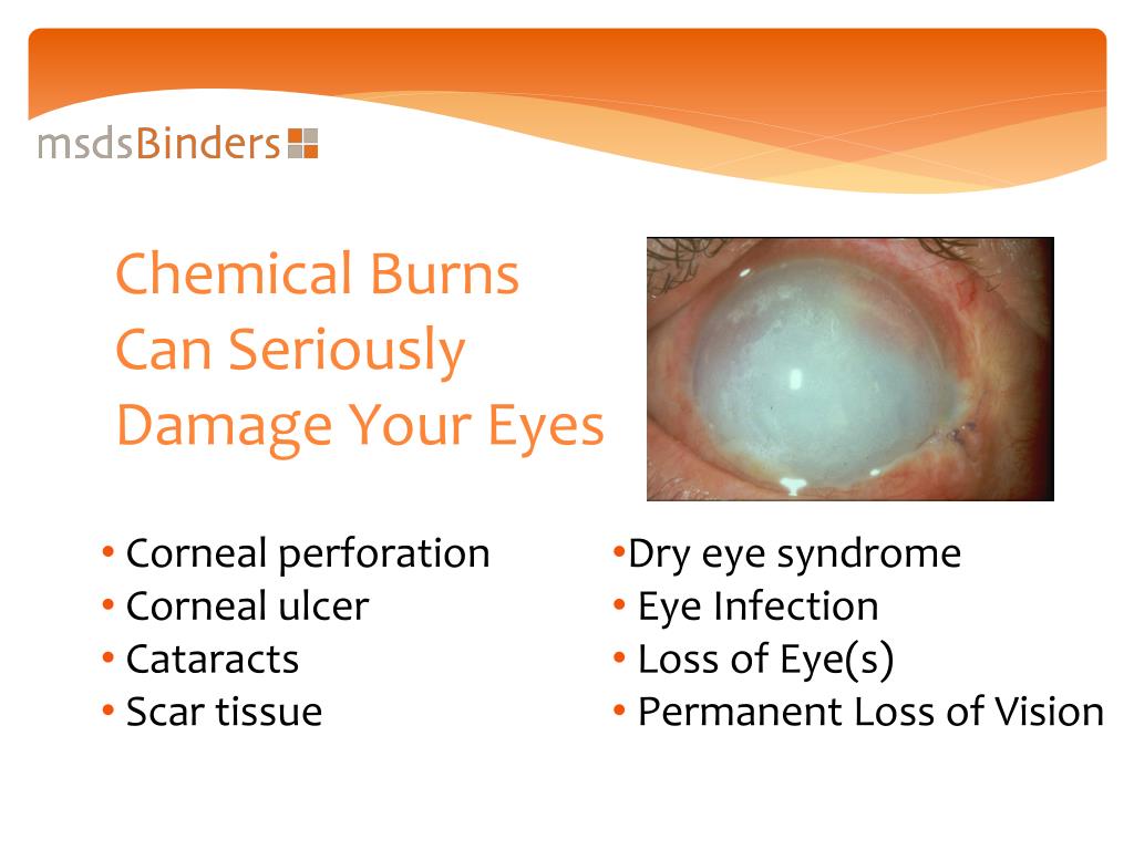PPT - Eye Health & Safety: Chemical Exposure in the Workplace ...
