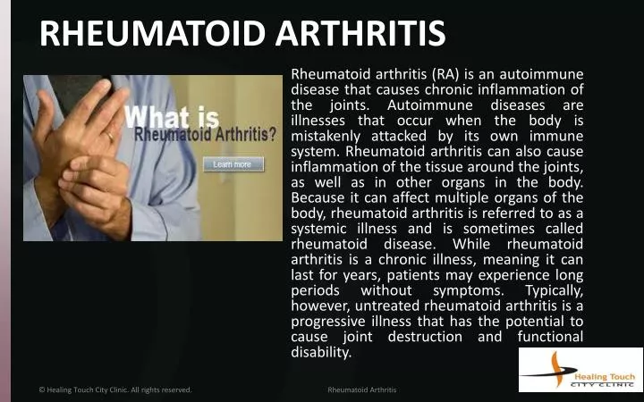 PPT - RHEUMATOID ARTHRITIS PowerPoint Presentation, free download - ID ...