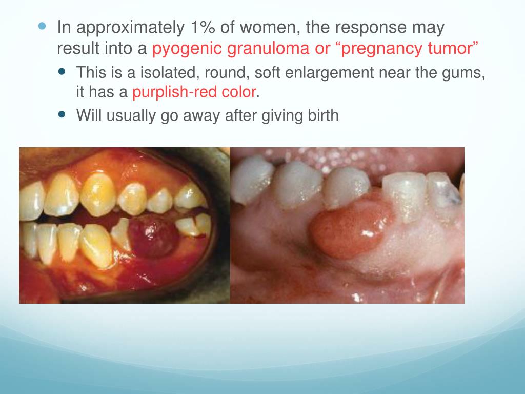 PPT - Pregnancy and Oral Hygiene PowerPoint Presentation, free download ...