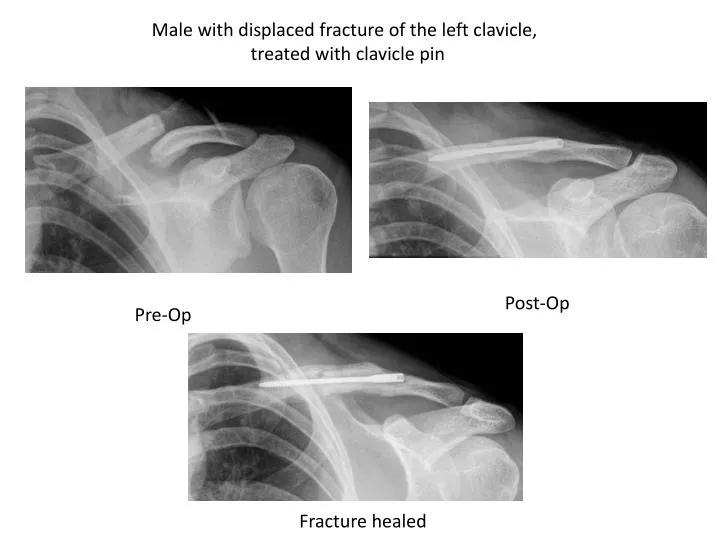 PPT - Male with displaced fracture of the left clavicle, treated with ...