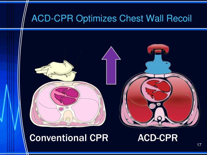 PPT - ACD-CPR with an ITD: Teaching Concepts PowerPoint Presentation ...