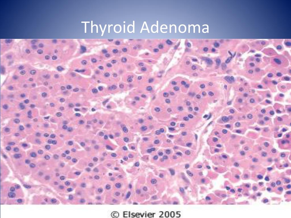 Ppt Thyroid Nodules And Neoplasms Powerpoint Presentation Free