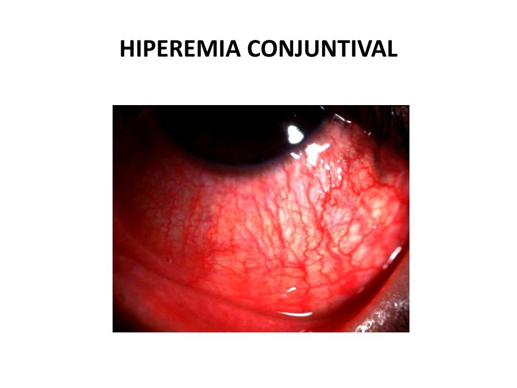 PPT - FISIOPATOLOGIA DE TRASTORNOS OCULARES FRECUENTES PowerPoint ...