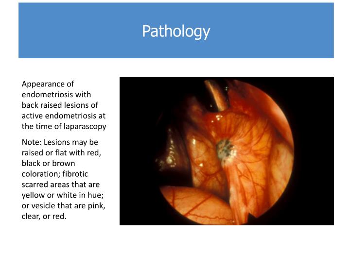 PPT - Endometriosis PowerPoint Presentation - ID:2600258