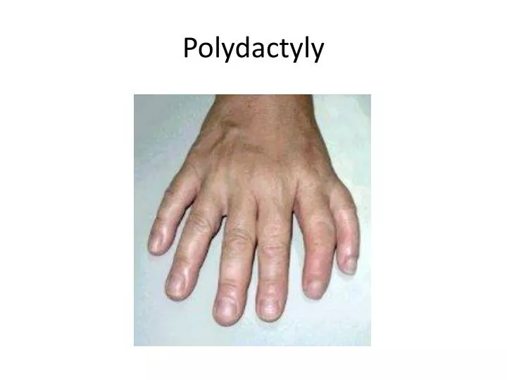 PPT - Polydactyly PowerPoint Presentation, free download - ID:2605265