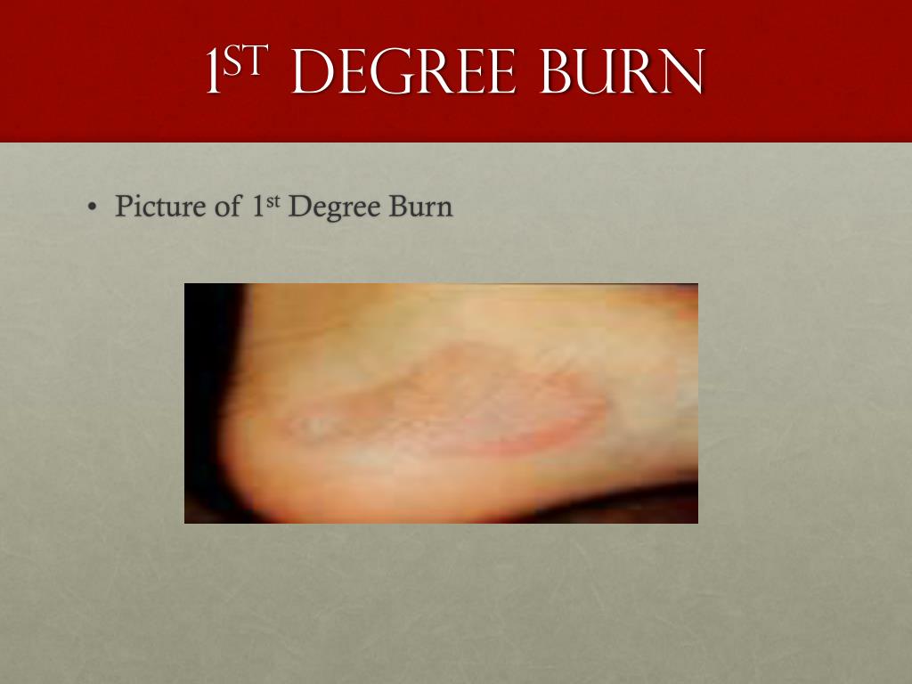 PPT - Understanding Skin Pigmentation and Burn Degrees: A Comprehensive ...