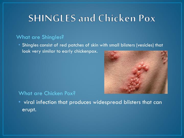 PPT - Chicken Pox and Shingles PowerPoint Presentation - ID:2643402