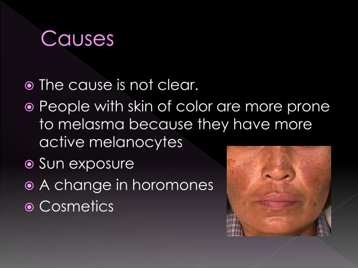 PPT - Melasma PowerPoint Presentation - ID:2644285