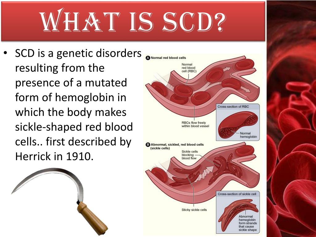 PPT SICKLE CELL DISEASE Scd PowerPoint Presentation Free 