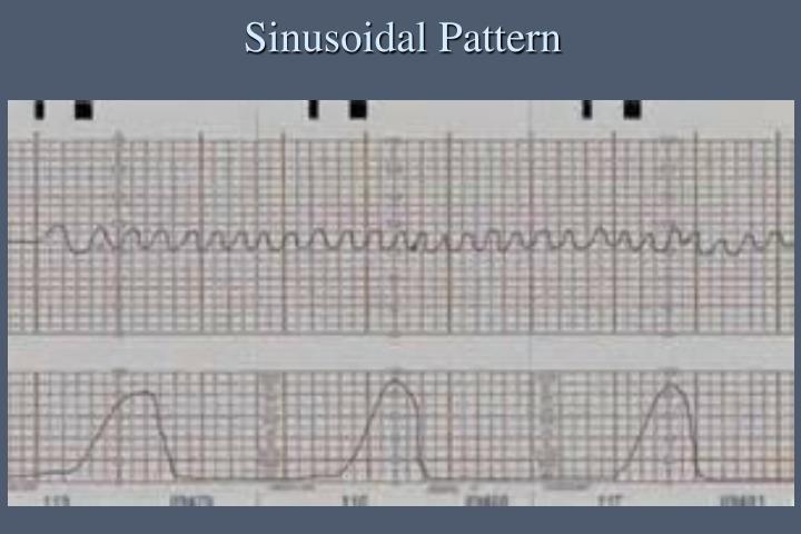 PPT - Fetal Heart Rate Monitoring PowerPoint Presentation - ID:2646802