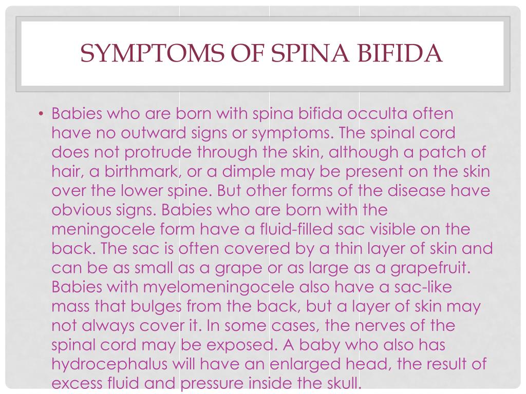 Ppt Spina Bifida Powerpoint Presentation Free Download Id 2656280