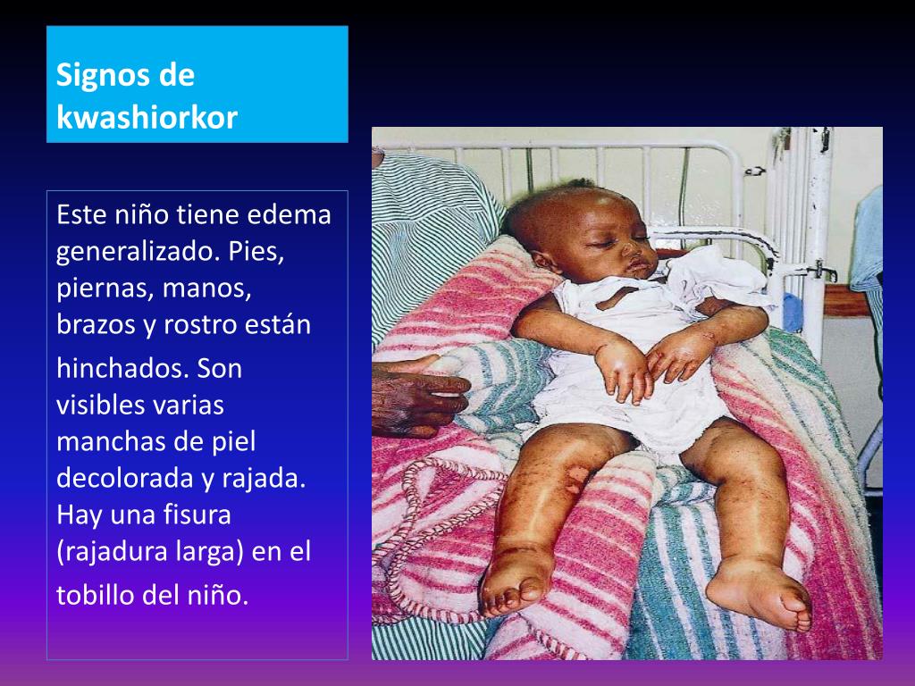 PPT - Los Patrones de Crecimiento del Niño de la OMS PowerPoint ...