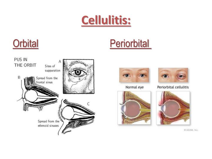 PPT - Orbital cellulitis PowerPoint Presentation - ID:2660889