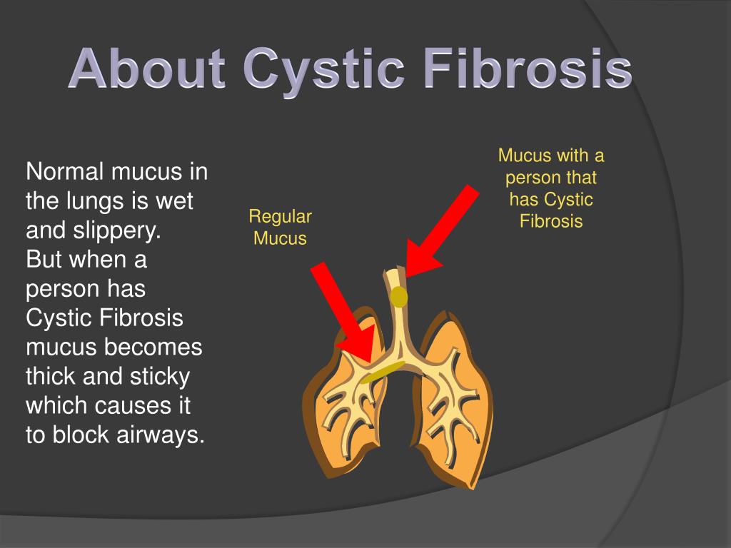 PPT - Cystic Fibrosis Disease PowerPoint Presentation, free download ...
