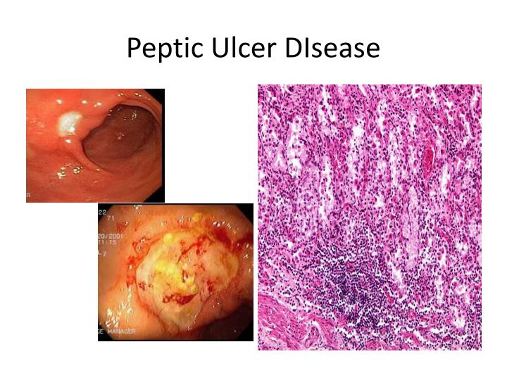 PPT - Gastric ulcers PowerPoint Presentation - ID:2668450