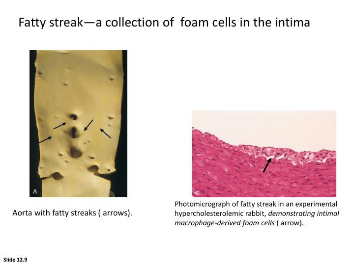 PPT - ATHEROSCLEROSIS PowerPoint Presentation - ID:2687171