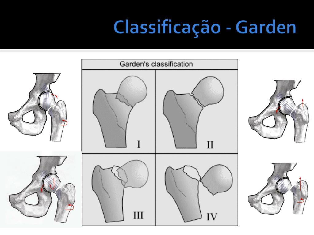 PPT - Fraturas de Colo de Fêmur, Transtrocanteriana e Cintura pélvica ...