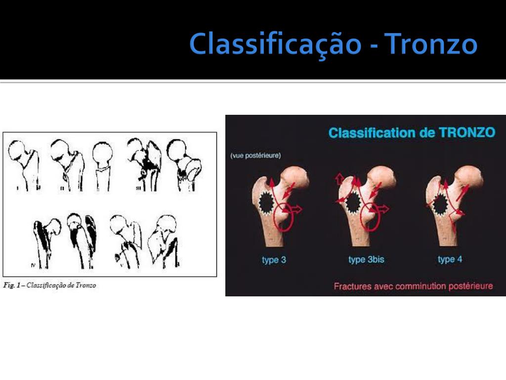 PPT - Fraturas de Colo de Fêmur, Transtrocanteriana e Cintura pélvica ...