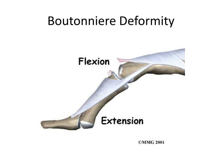 PPT - Common Wrist, Hand, & Finger Injuries PowerPoint Presentation ...