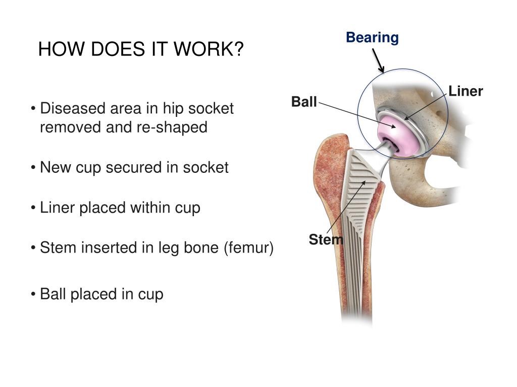 PPT - Treatment Options for your Hip Pain PowerPoint Presentation, free ...