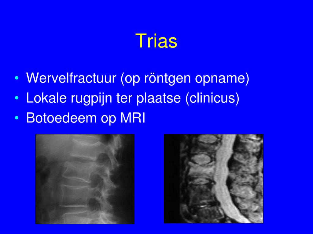 PPT - Vertebroplastiek bij osteoporotische wervelfracturen PowerPoint ...