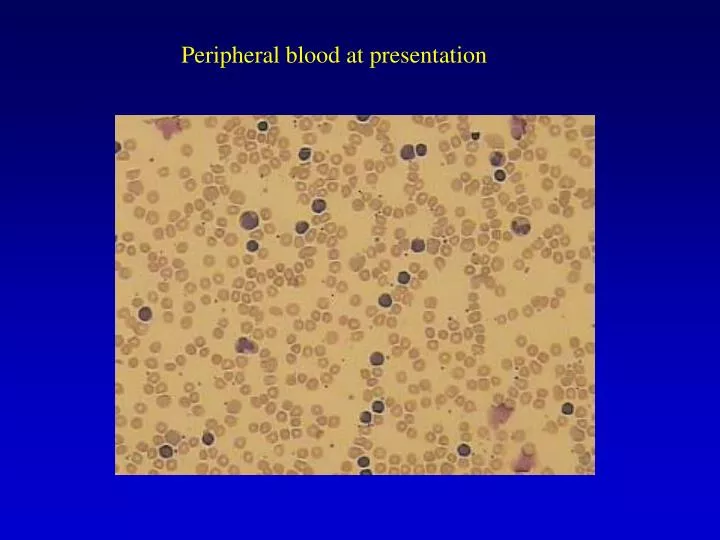 PPT - Peripheral blood at presentation PowerPoint Presentation, free ...