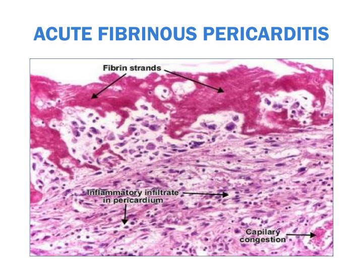 PPT - Inflammation and repair PowerPoint Presentation - ID:2708504