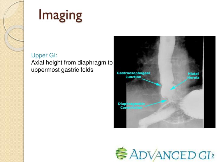 PPT - Endoscopic Diagnosis of Hiatal Hernia PowerPoint Presentation ...