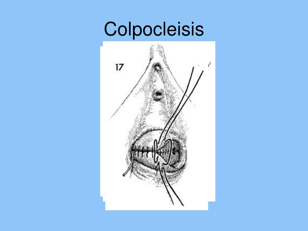 PPT - Urogyn CREOG Review 12/15/2010 Barbara L. Robinson PowerPoint ...