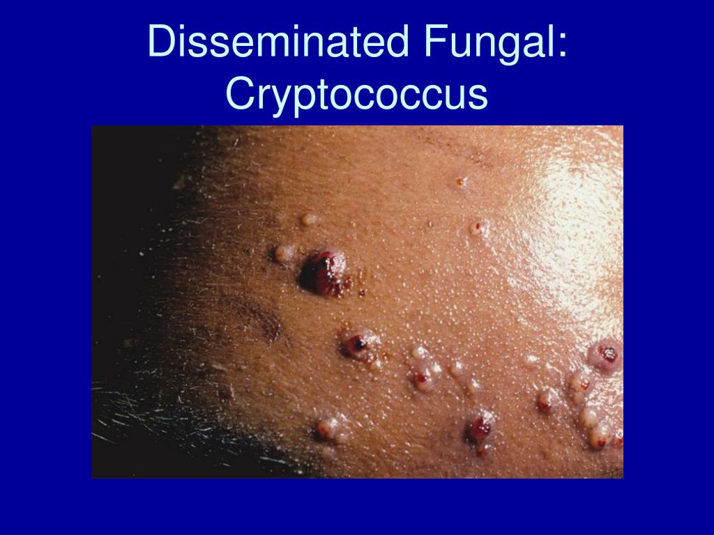 PPT - Clinical Aspects of HIV Disease PowerPoint Presentation, free ...